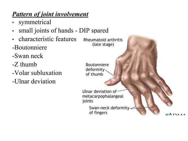 Polyarthritis (clinical approach) | PPTX | Bone and Joint Conditions ...