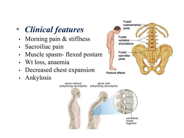 Polyarthritis (clinical approach) | PPTX | Bone and Joint Conditions ...