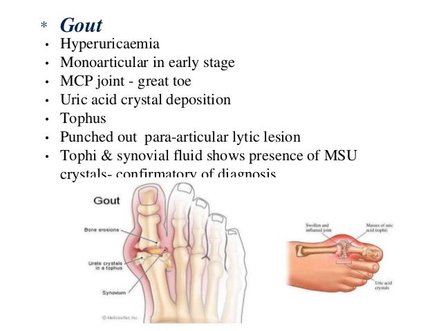 Polyarthritis (clinical approach)