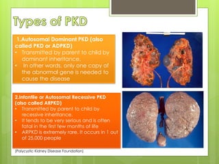 Polycystic kidney disease | PPTX
