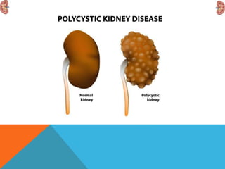Polycystic kidney disease (PCKD) | PPSX