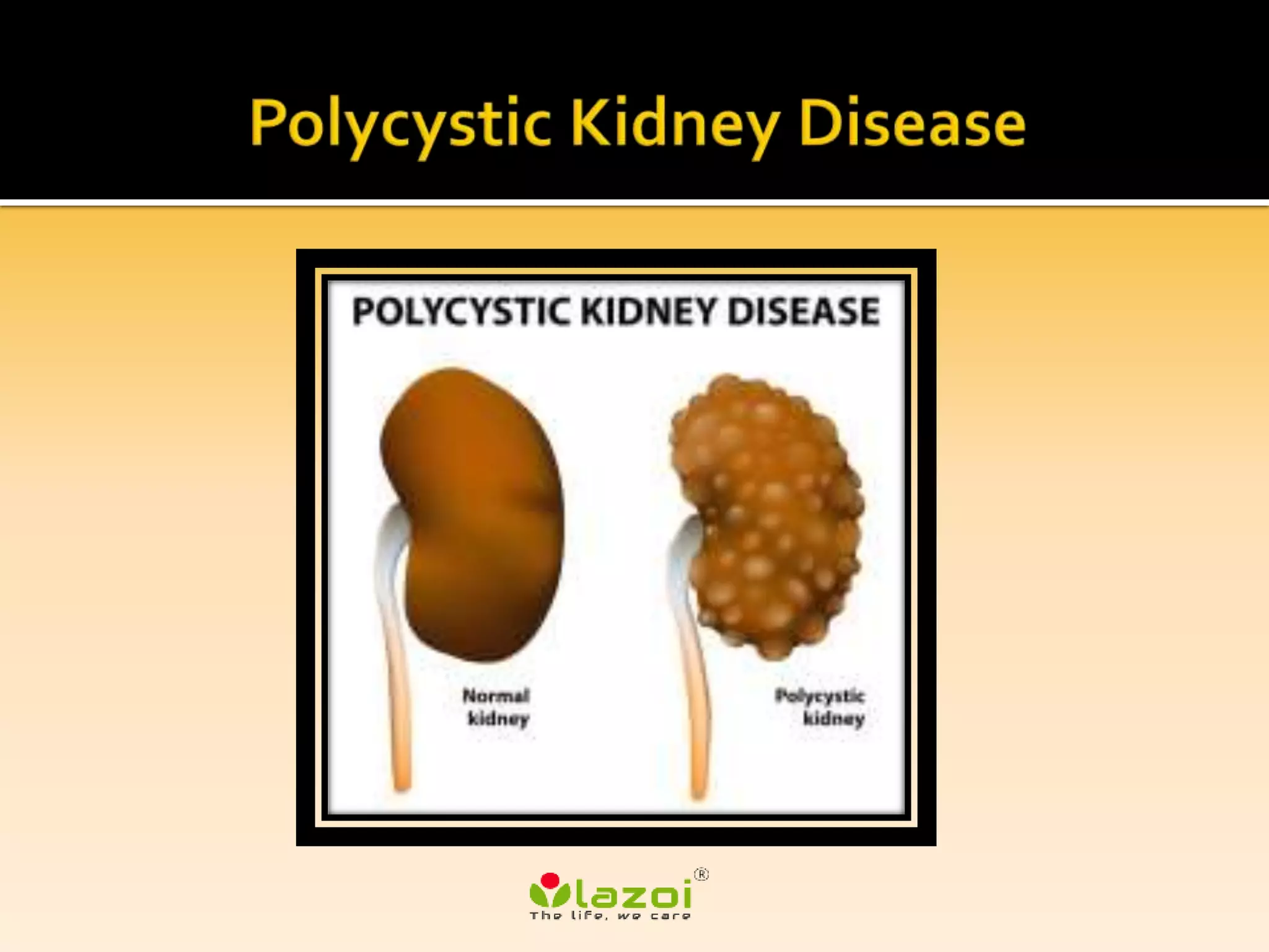 Polycystic kidney disease | PPTX