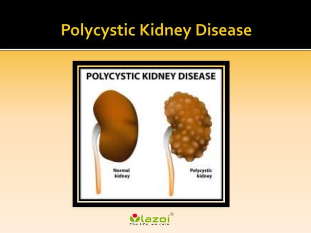 Polycystic kidney disease | PPTX | Blood Disorders | Diseases and ...
