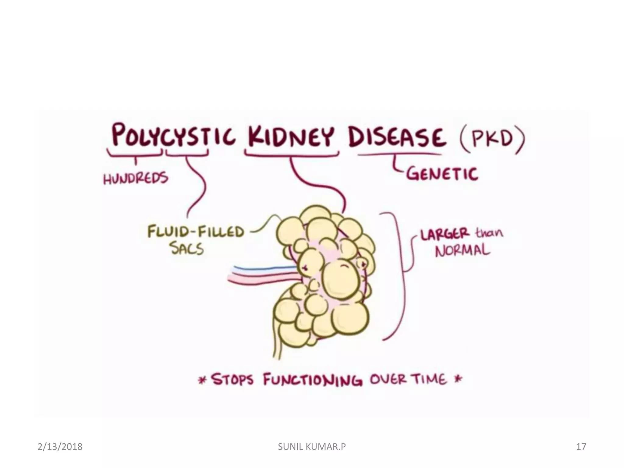 Poly cystic kidney disease | PPTX