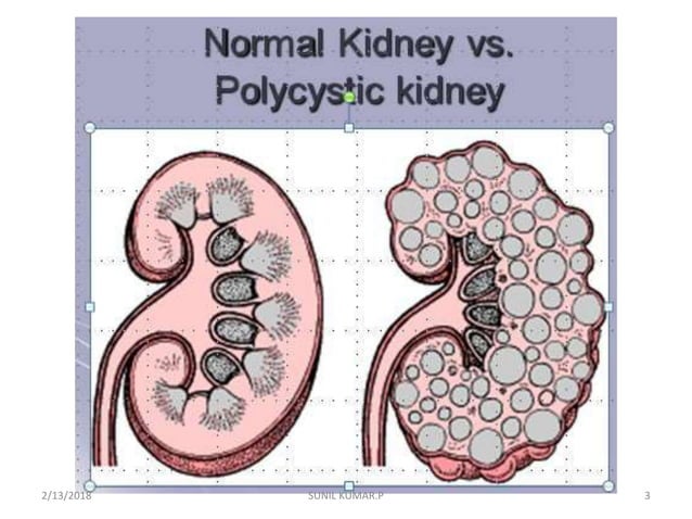 Poly cystic kidney disease | PPTX