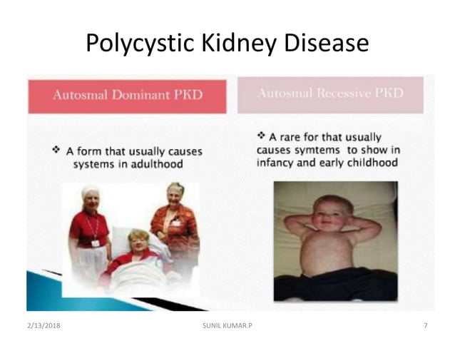 Poly cystic kidney disease | PPTX