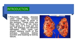 POLYCYSTIC KIDNEY DISEASE FOR NURSING | PPTX | Lung and Respiratory Health | Diseases and Conditions