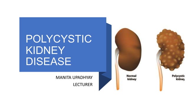 POLYCYSTIC KIDNEY DISEASE FOR NURSING | PPT