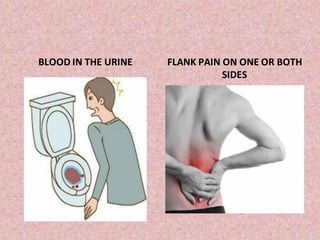 Polycystic kidney disease | PDF