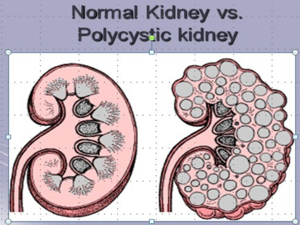 Polycystic kidney disease for students