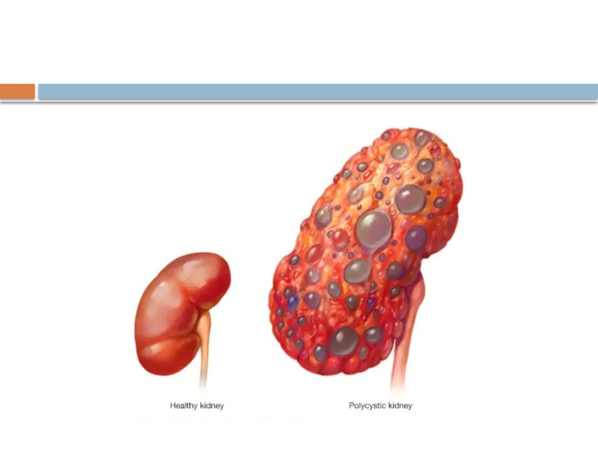 Polycystic Kidney Disease (PCKD).pptx... | PPT
