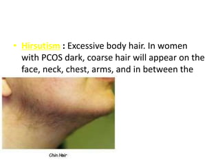 Polycystic ovarian cancer | PPTX