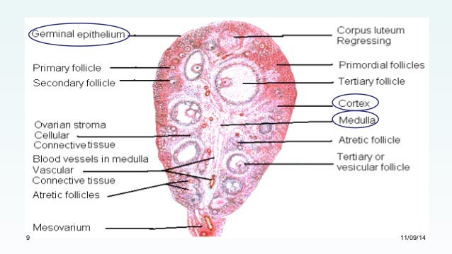 Polycystic ovarian disease by Dr.Shuchita Chattree