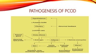 Polycystic ovarian disease | PPT