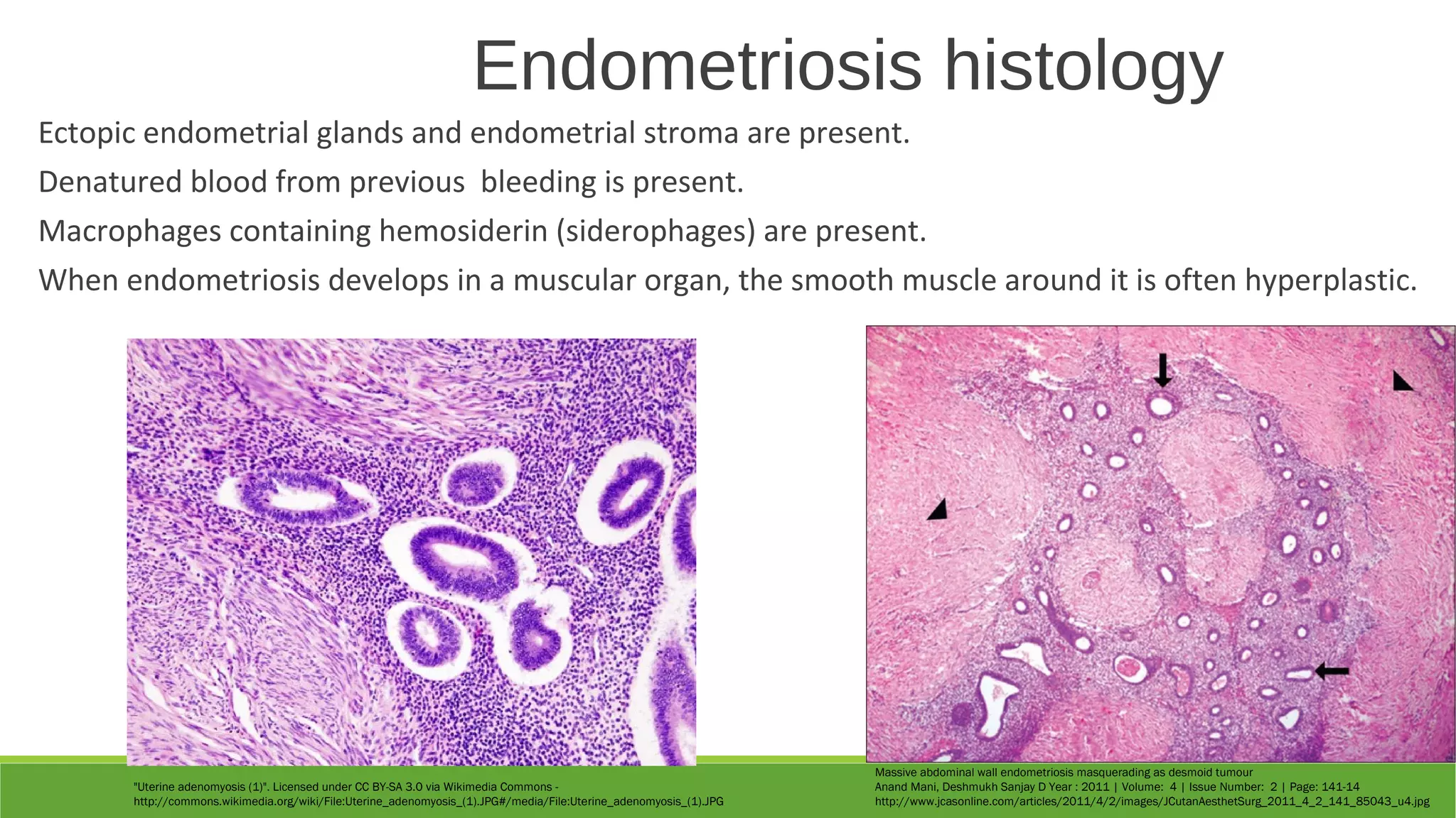 Pathology of Polycystic ovarian disease and endometriosis 2018 sufia ...