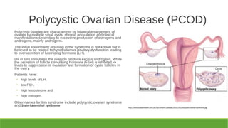 Pathology of Polycystic ovarian disease and endometriosis 2018 sufia ...