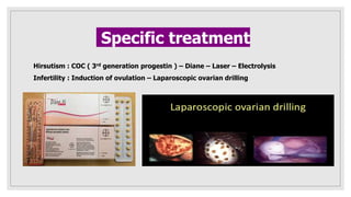 Polycystic ovarian syndrome | PPT