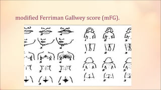 POLYCYSTIC OVARIAN SYNDROME.pdf
