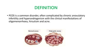 Polycystic Ovarian Syndrome.pptx