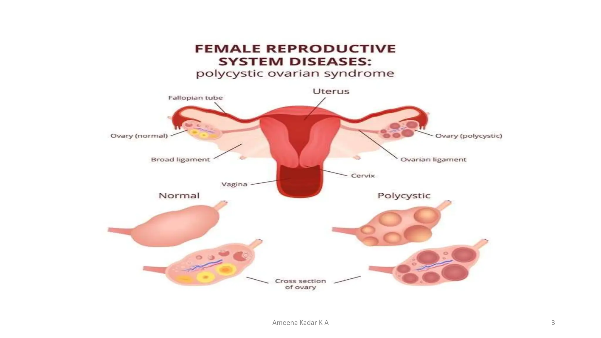 POLYCYSTIC OVARIAN SYNDROME (PCOS)...... | PPTX