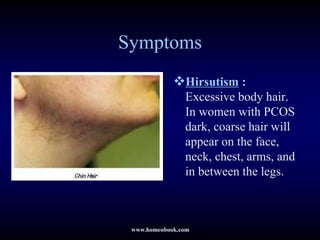 Polycystic ovarian syndrome(1).pdf
