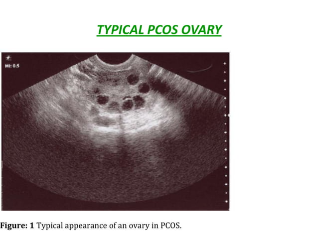 Polycystic ovarian syndrome | PPTX
