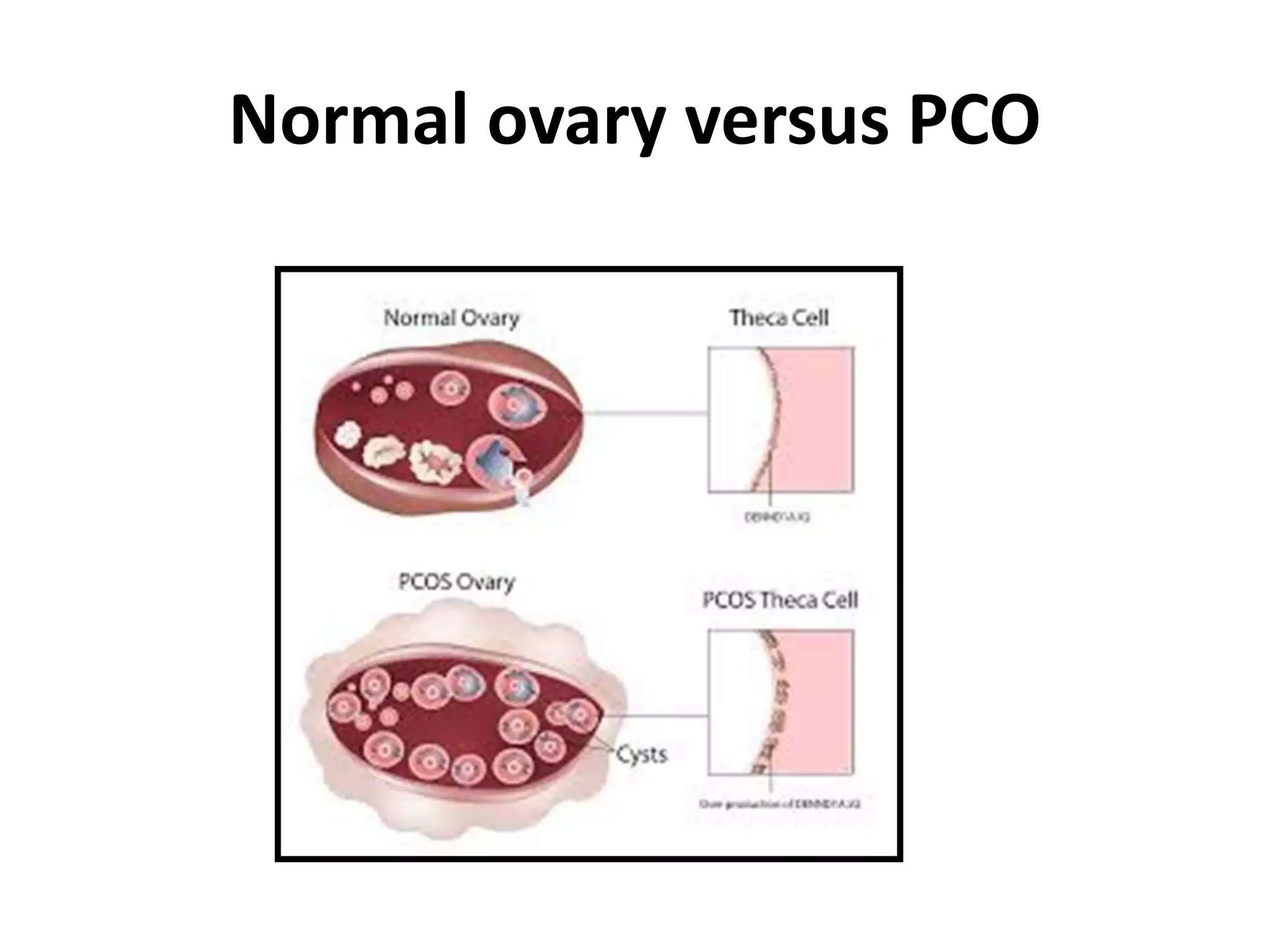 Polycystic Ovarian Syndrome (PCOS) | PDF
