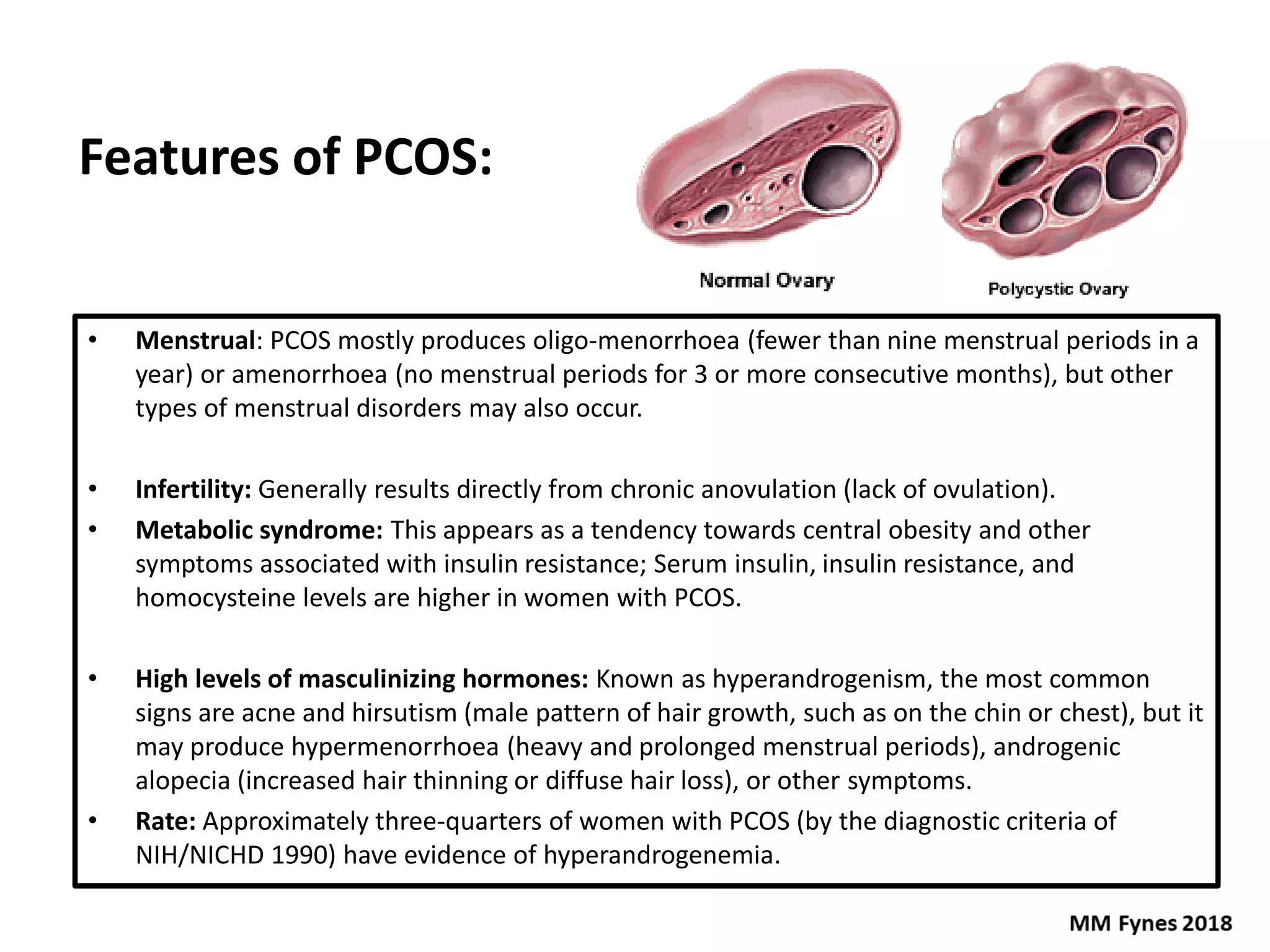 Polycystic Ovarian Syndrome (PCOS) | PDF