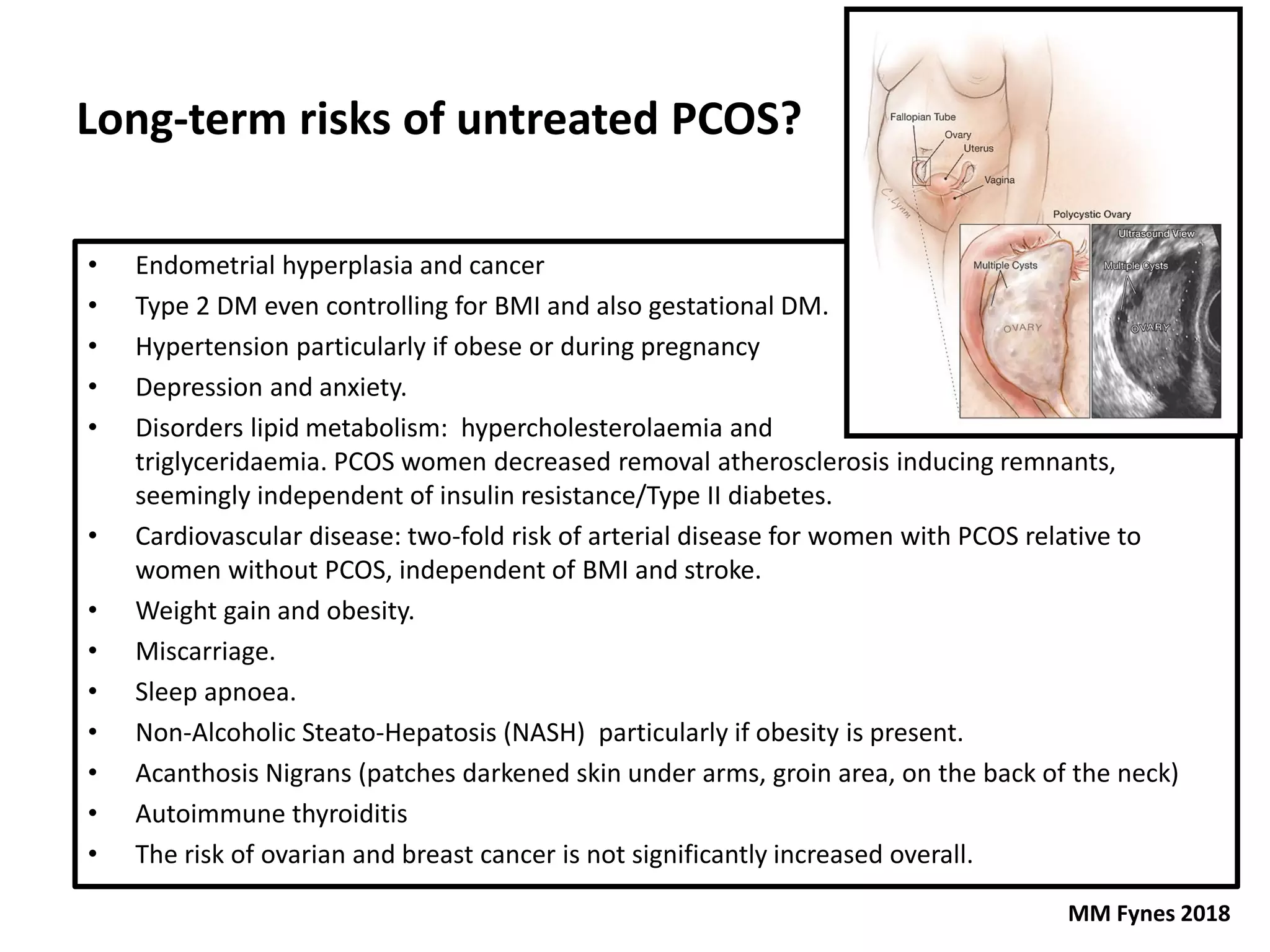 Polycystic Ovarian Syndrome (PCOS) | PDF