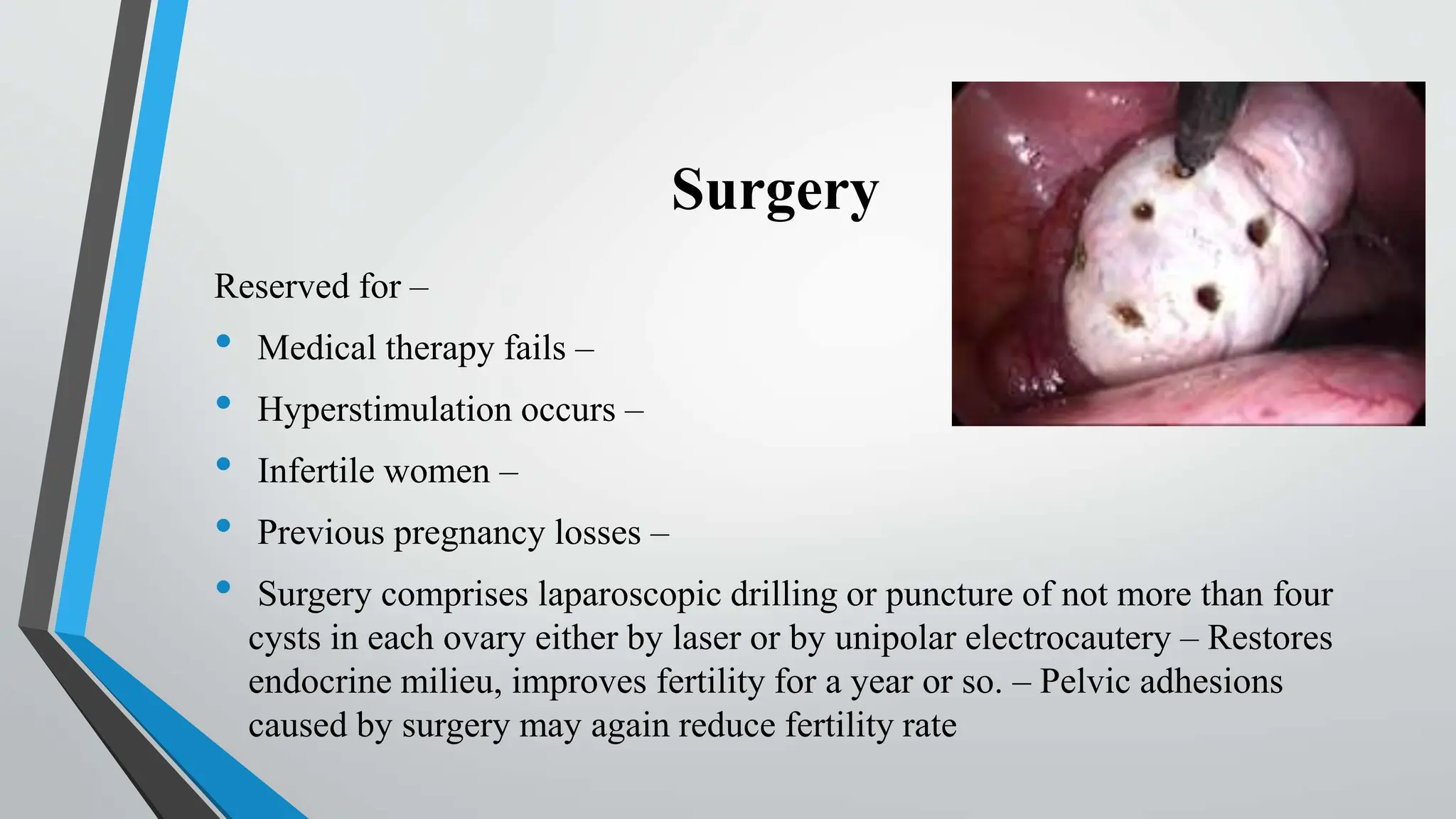 Polycystic ovary syndrome history, modern and unani approach ppt.pptx