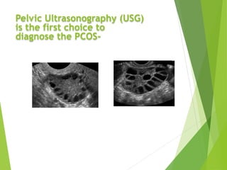 Treatment of Polycystic Ovary Syndrom (PCOS) | PPTX