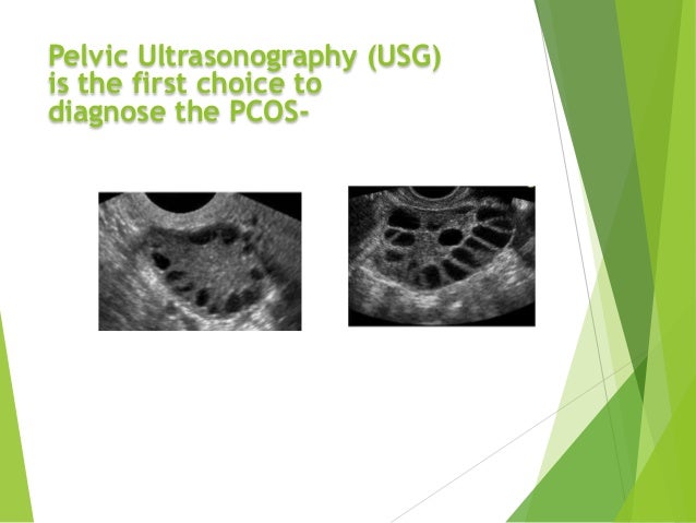 Treatment of Polycystic Ovary Syndrom (PCOS)