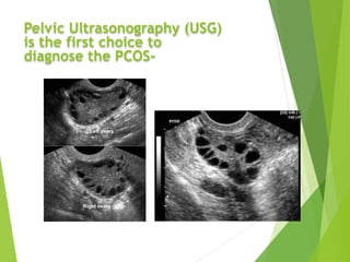 Treatment of poly-cystic ovary syndrom (PCOS) | PPTX