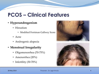 Polycystic ovary syndrome | PPTX
