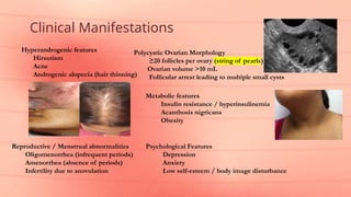 Polycystic Ovary Syndrome according to sa | PPTX