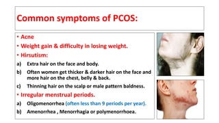 Polycystic ovary syndrome (pcos) with role of physical therapy. | PPTX