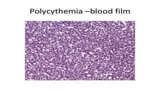 Polycythemia | PPTX