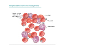 Polycythemia | PPT