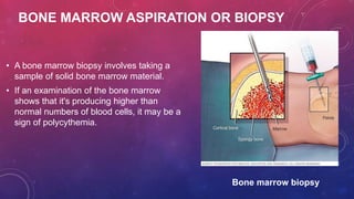 Polycythemia | PPTX