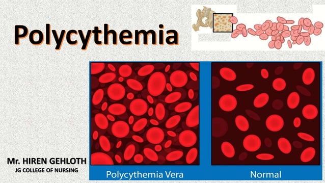 Polycythemia | PPTX