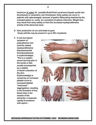Polycythemia by dr magdi sasi 2014 | PDF