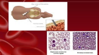 Polycythemia( Erythremia )by Divyansh.pptx