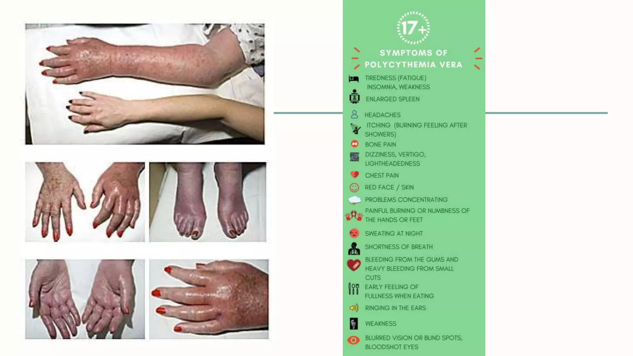 Polycythemia vera | PPTX | Blood Disorders | Diseases and Conditions