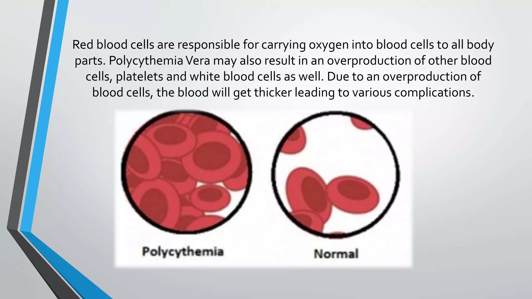 Polycythemia vera | PPTX
