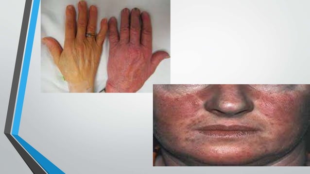 Polycythemia vera | PPTX