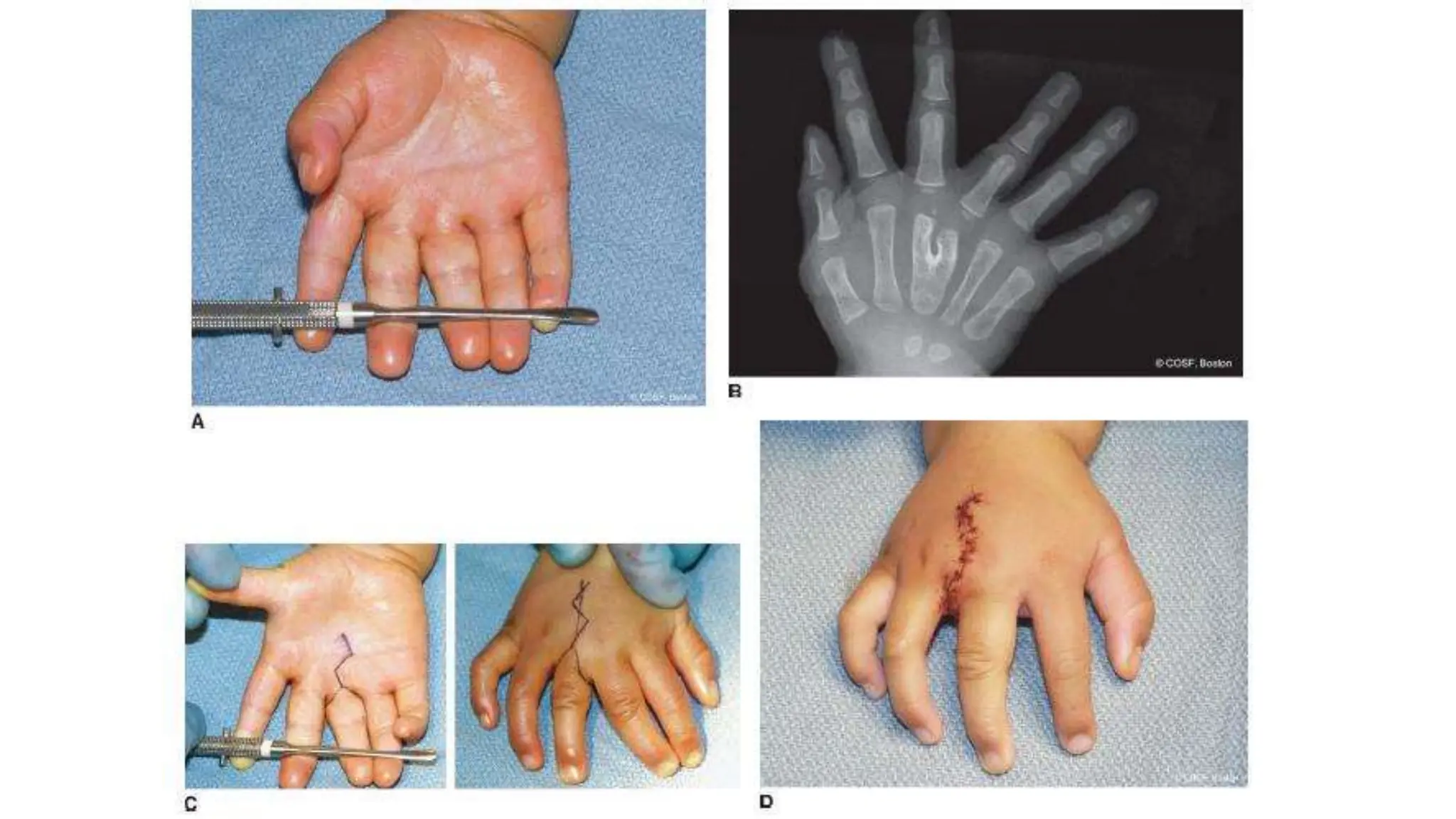 POLYDACTALY.pptx