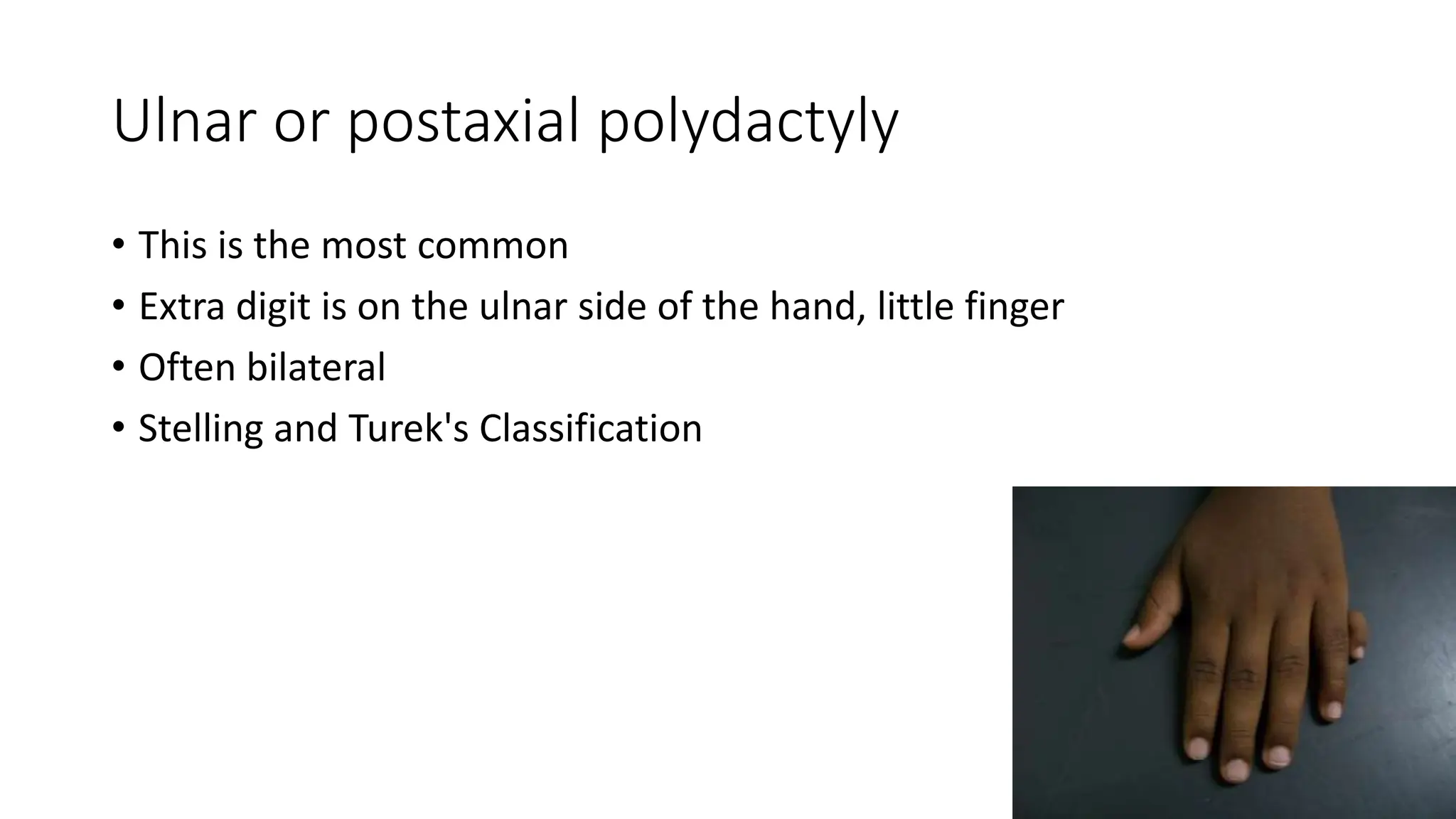 POLYDACTALY.pptx