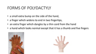 POLYDACTALY.pptx