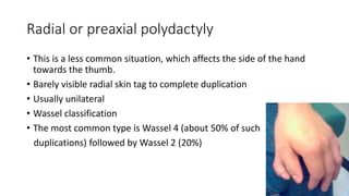 POLYDACTALY.pptx