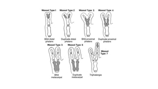 POLYDACTALY.pptx